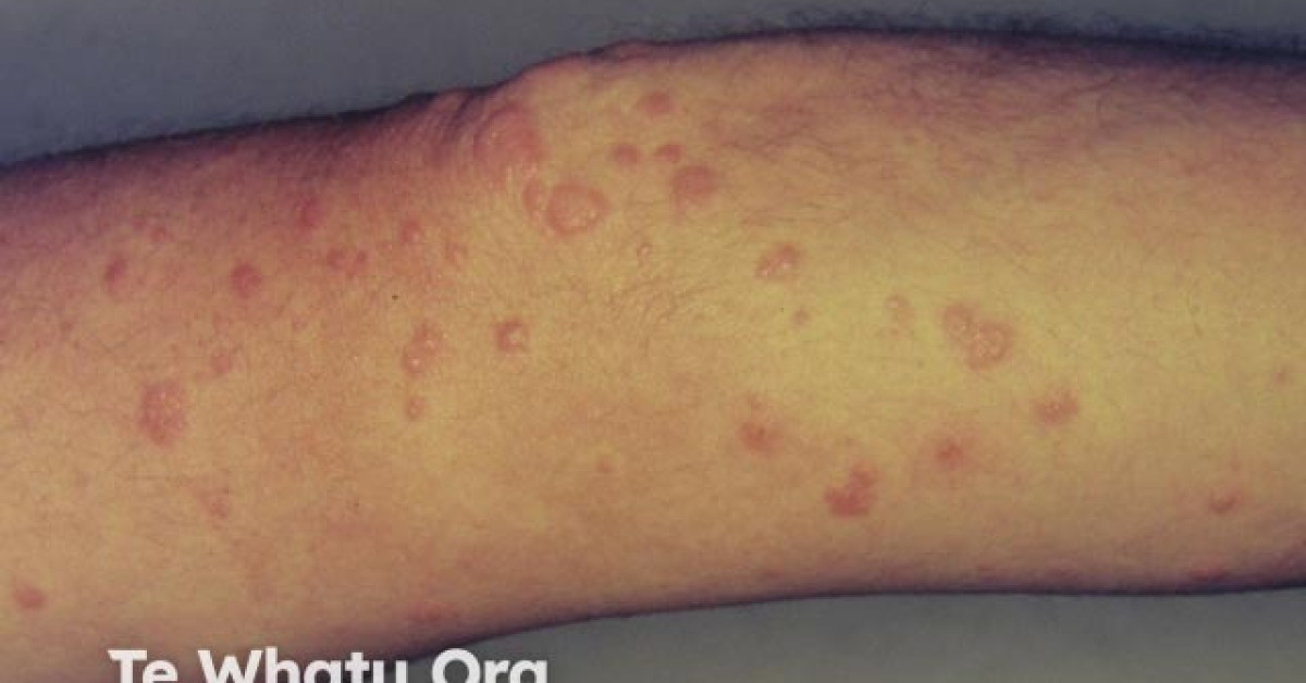 DermNet® - Orf image