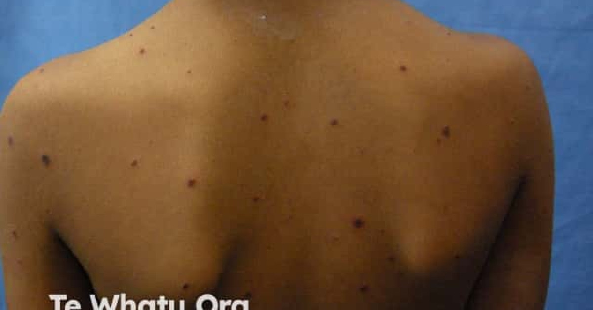 Chickenpox image