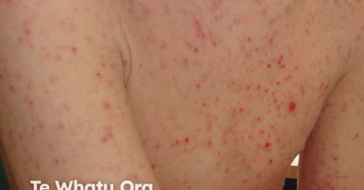 Chickenpox image
