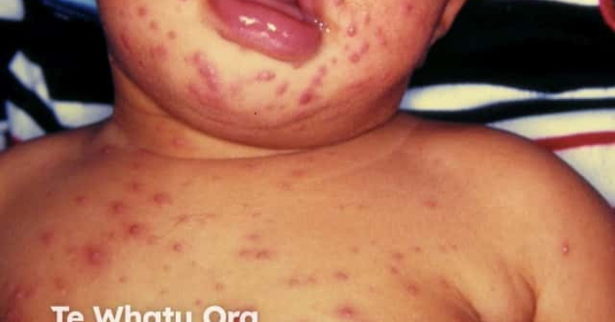 Chickenpox image