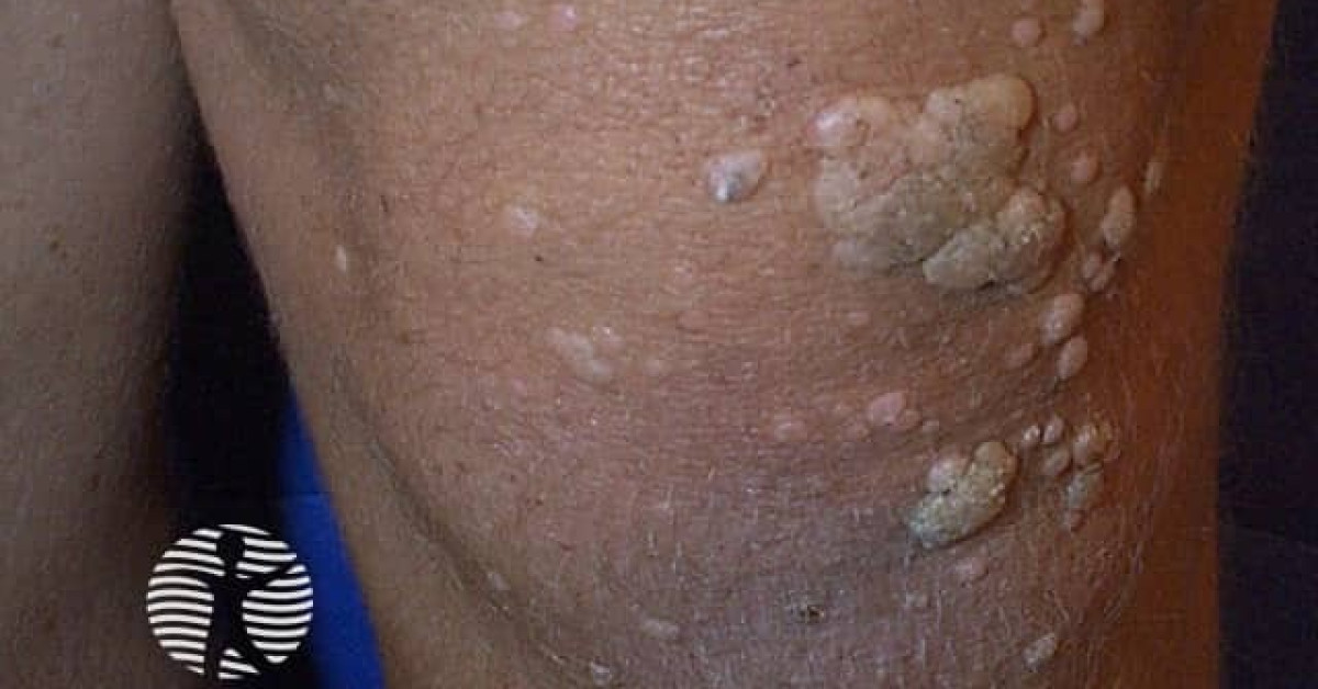 Viral warts image