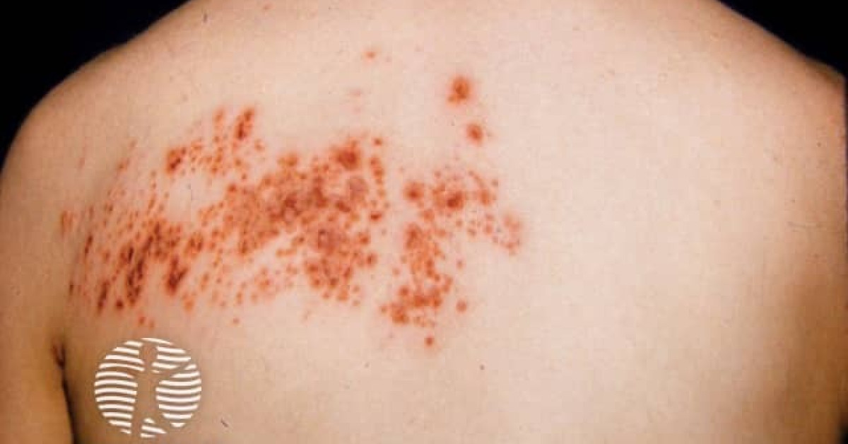 Herpes zoster image