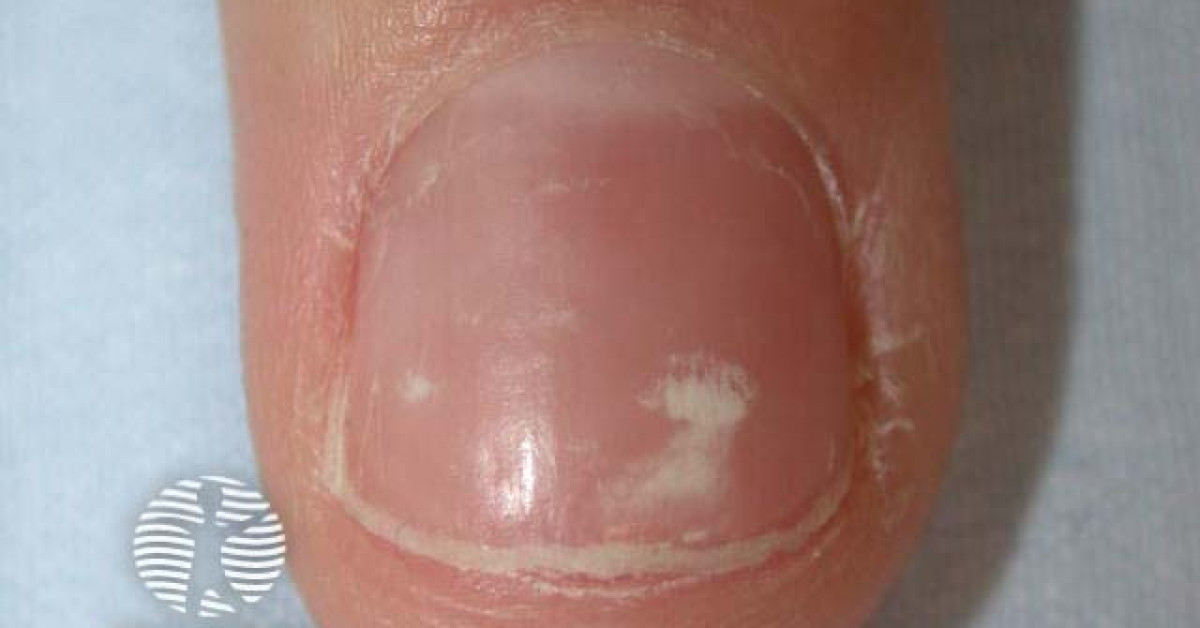 Punctate leukonychia image