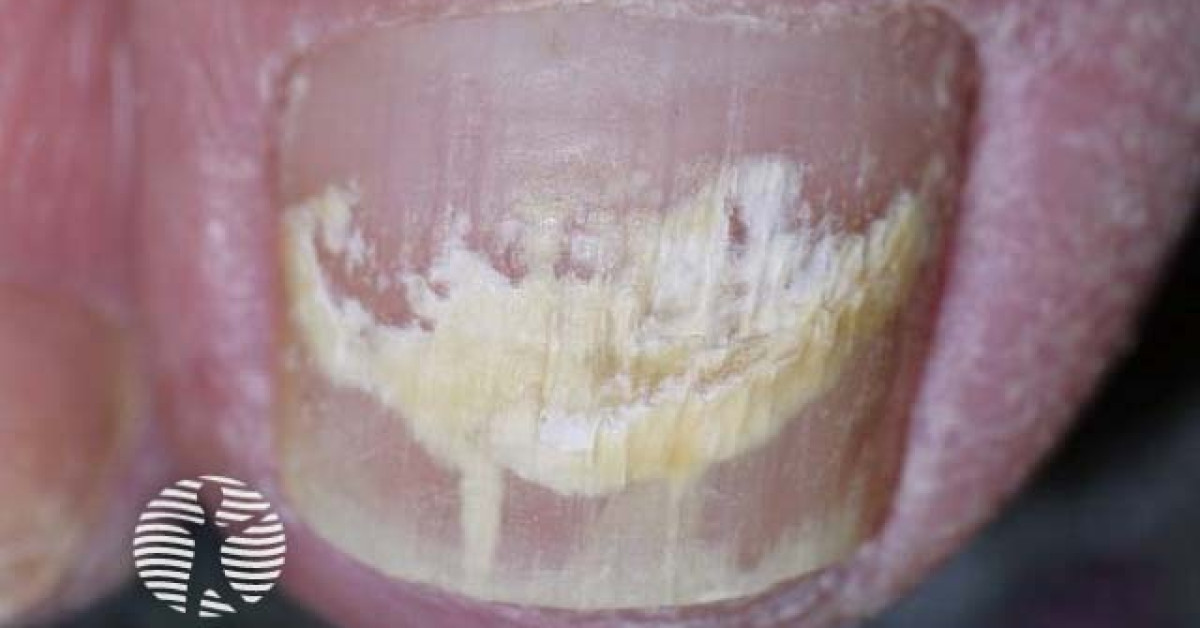 Superficial white onychomycosis 3 image Superficial white onychomycosis 3 image