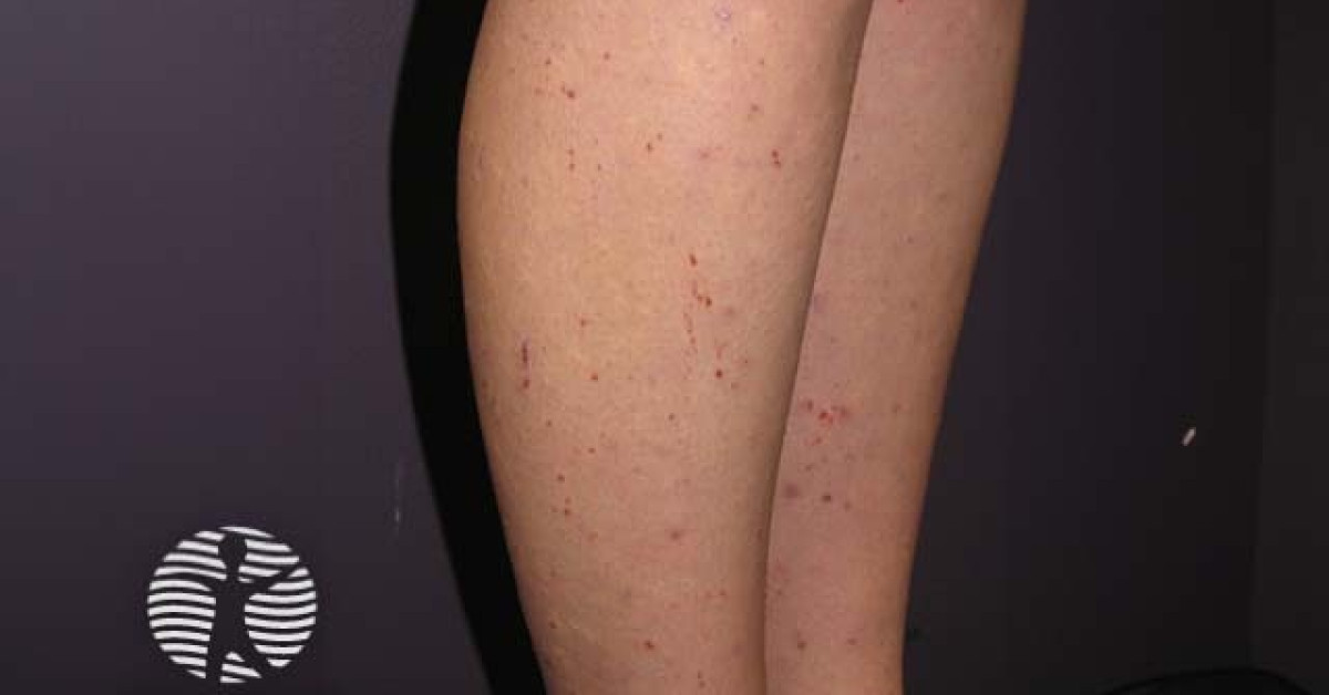 Excoriations in apparently normal skin image