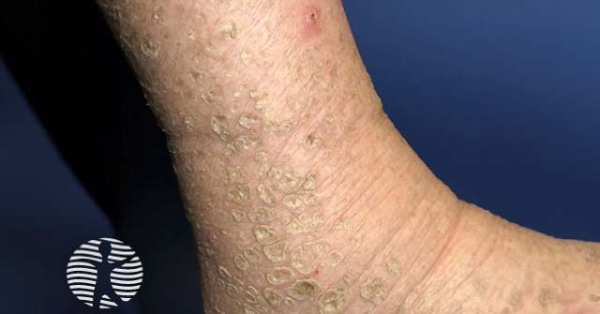 X linked ichthyosis image