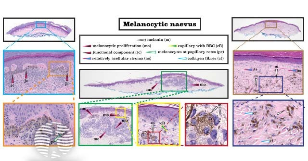 Histopathology of melanocytic naevus image