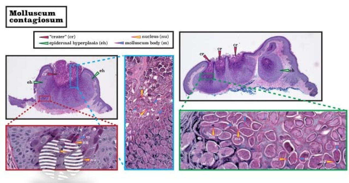 Histopathology of molluscum image