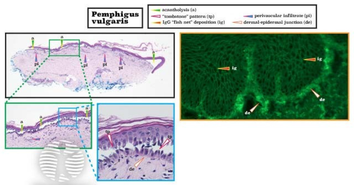 Histopathology of pemphigus vulgaris image