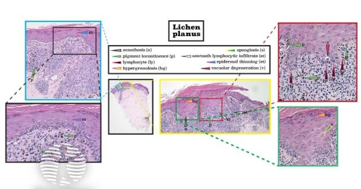 Histopathology of lichen planus image