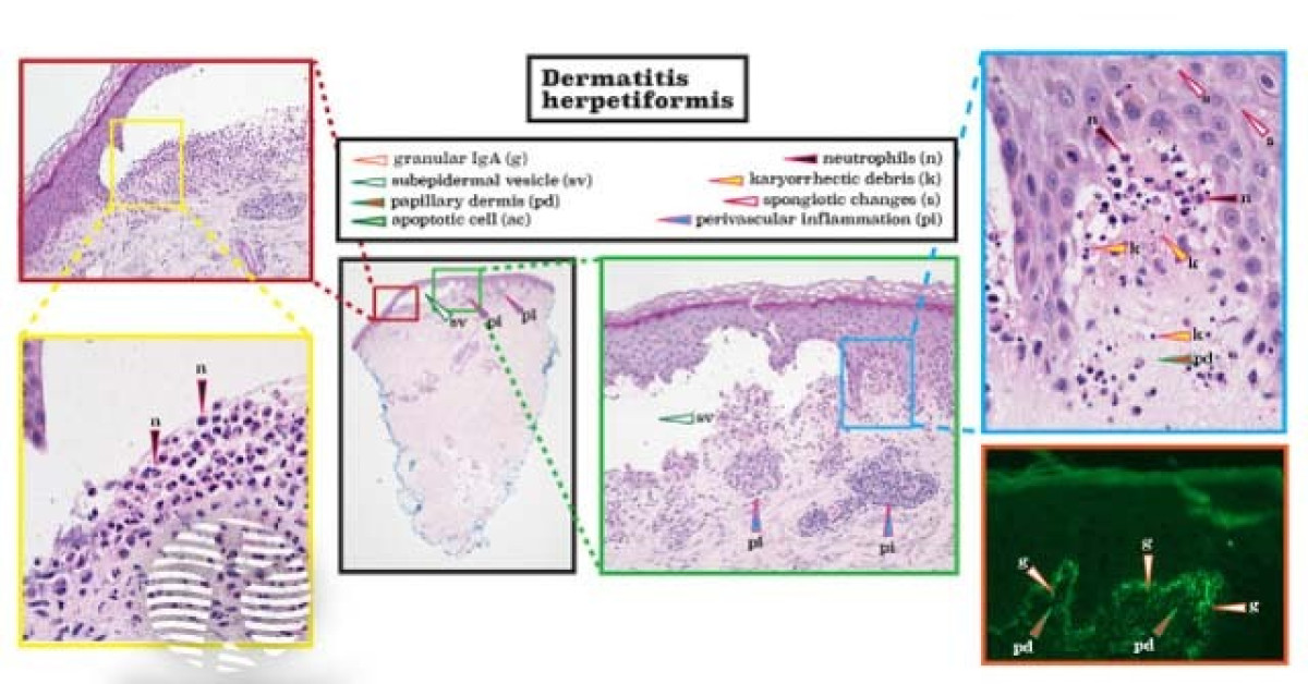 Histopathology of dermatitis herpetiformis image