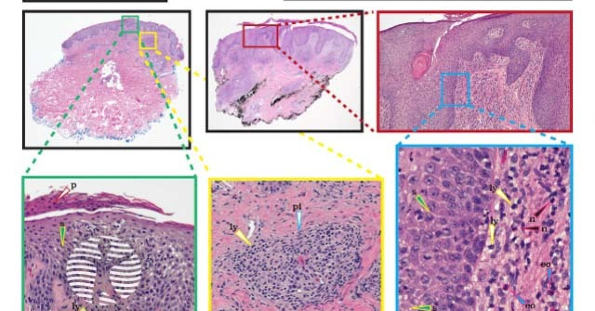 Histopathology of drug eruption image