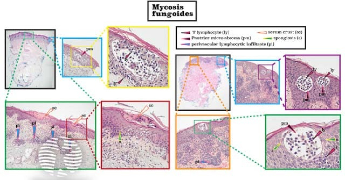 Histopathology of mycosis fungoides image