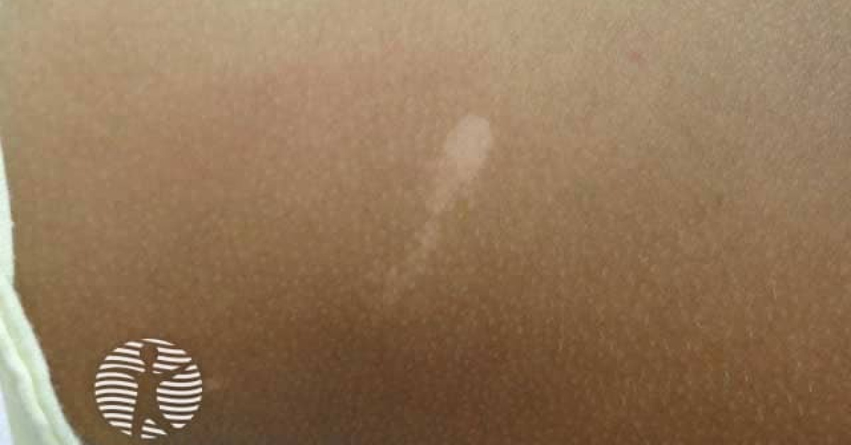 achromic naevus 00002 image