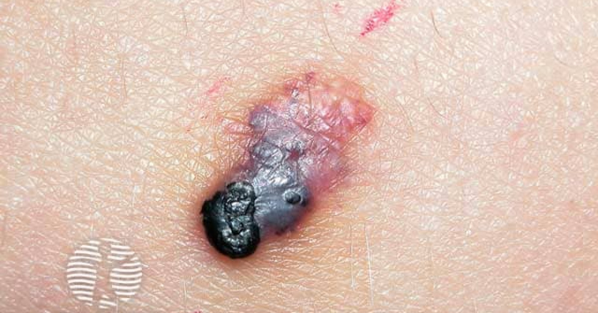 angiokeratoma 00001 image