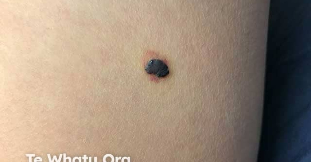 angiokeratoma 00005 image