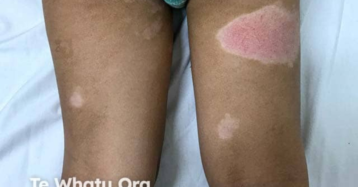 Atopic Dermatitis Skin of Colour image