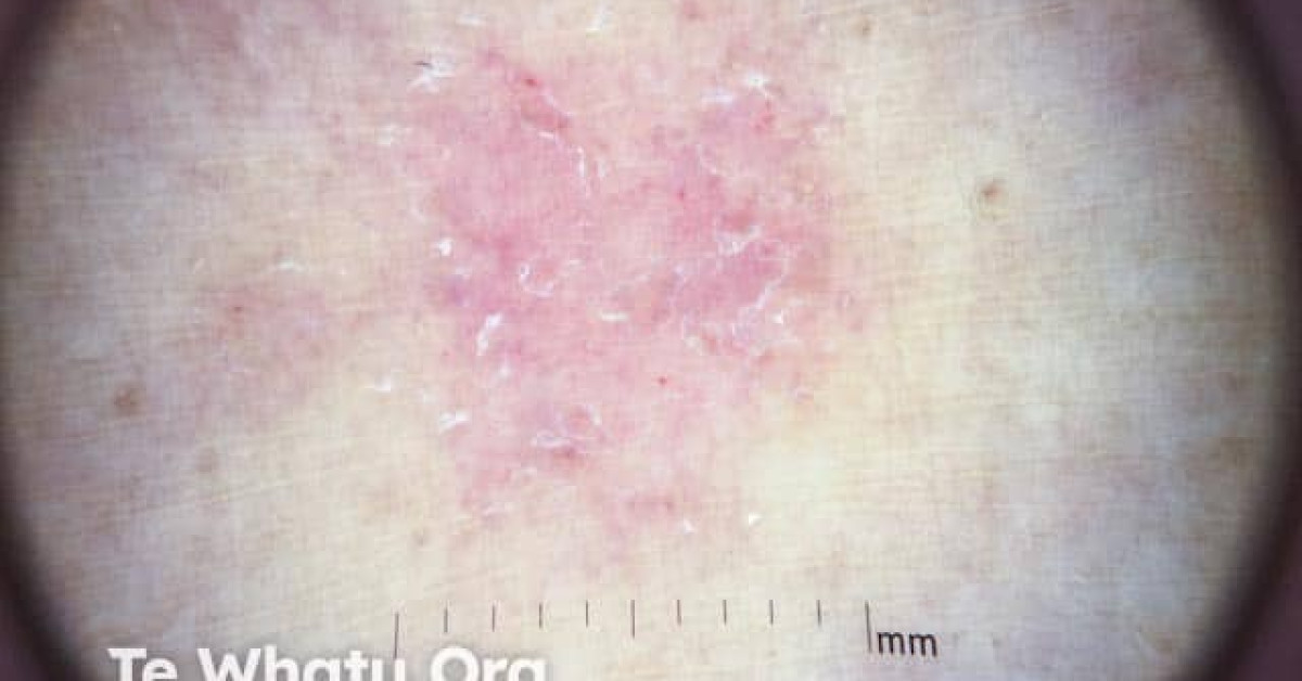 Atopic Dermatitis Skin of Colour image