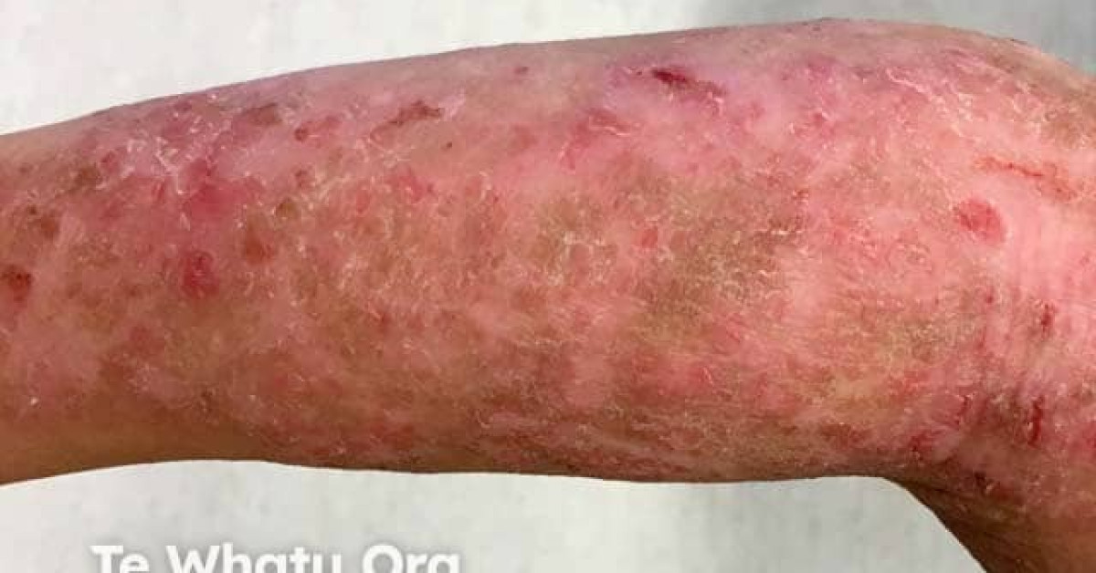 Atopic Dermatitis Skin of Colour image