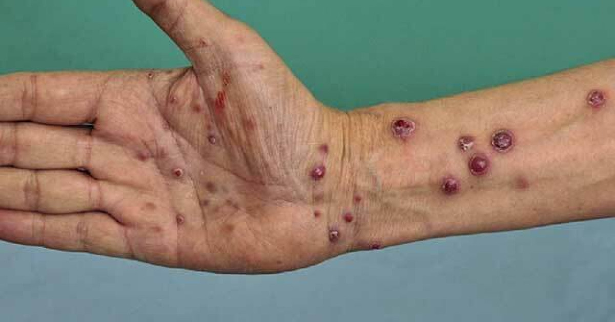 Bacillary angiomatosis image