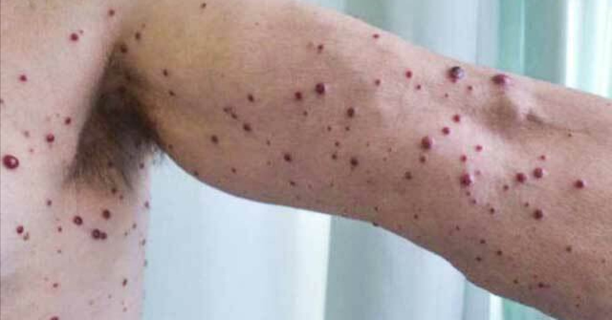 Bacillary angiomatosis image