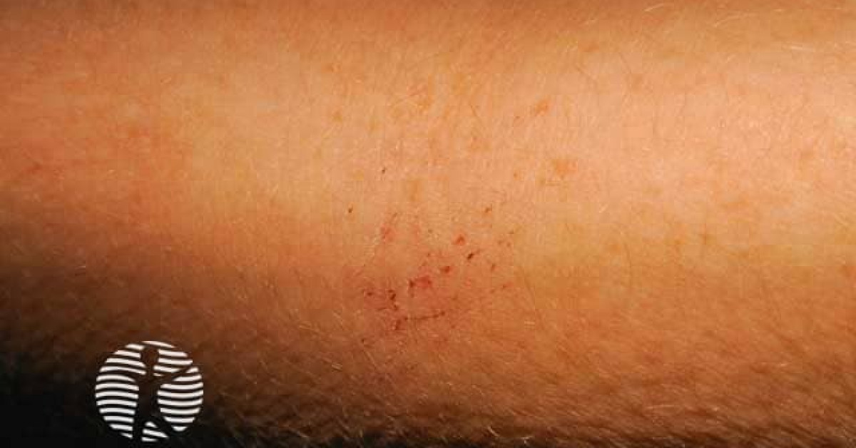 Brachioradial pruritus image