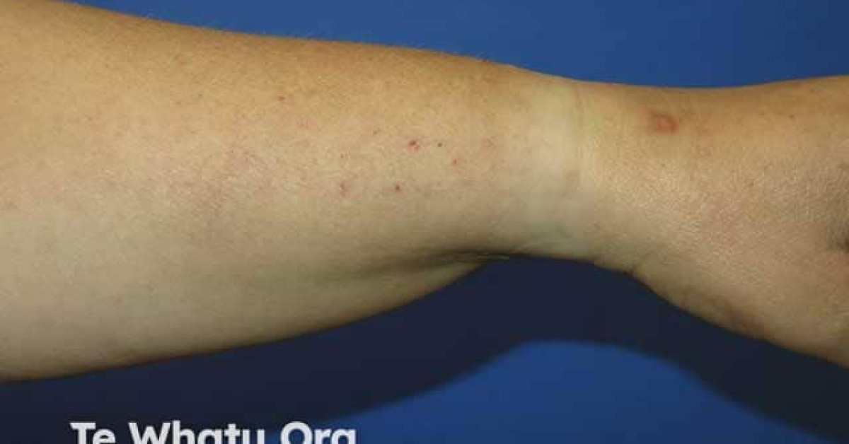 Brachioradial pruritus image