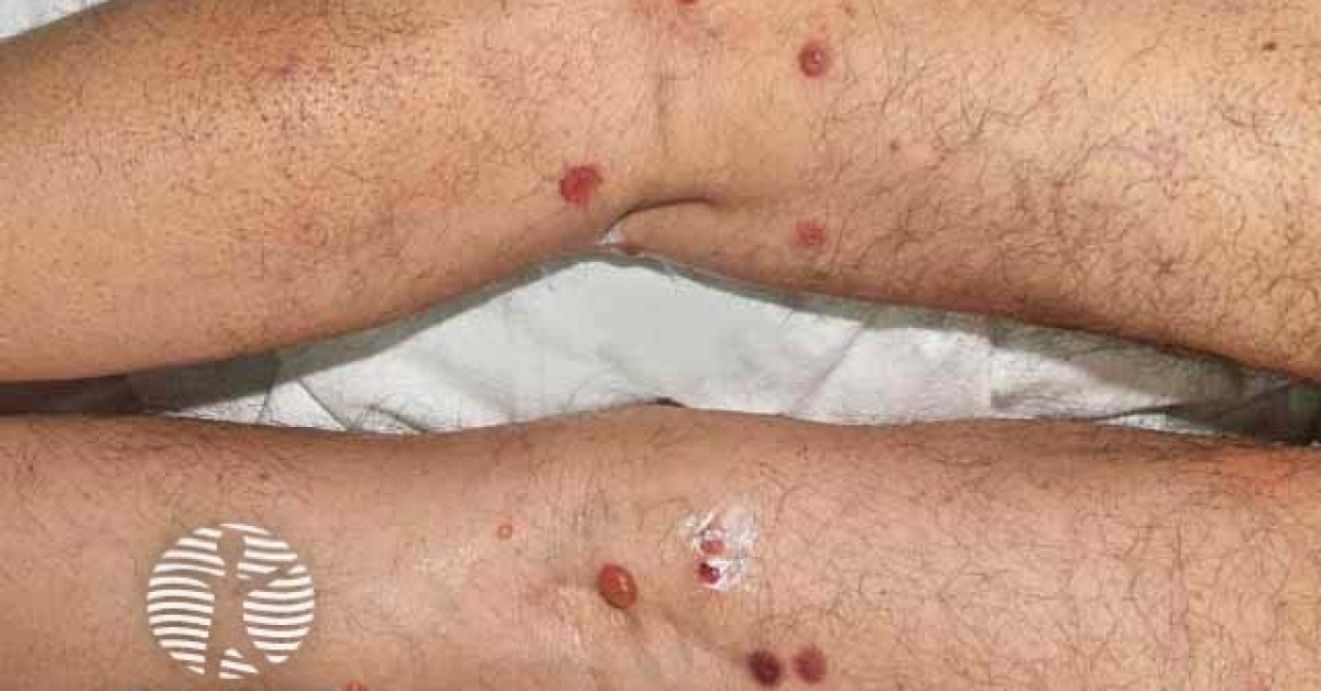 Bullous pemphigoid image