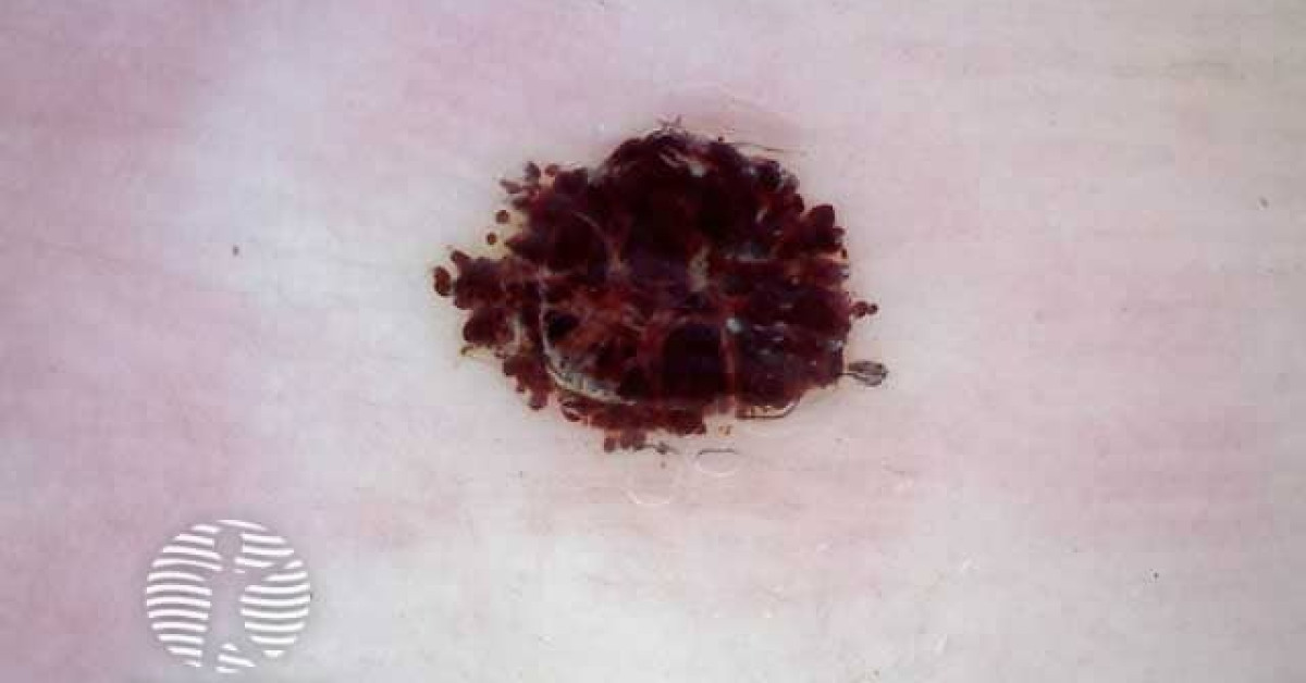 Calcaneal petechiae image