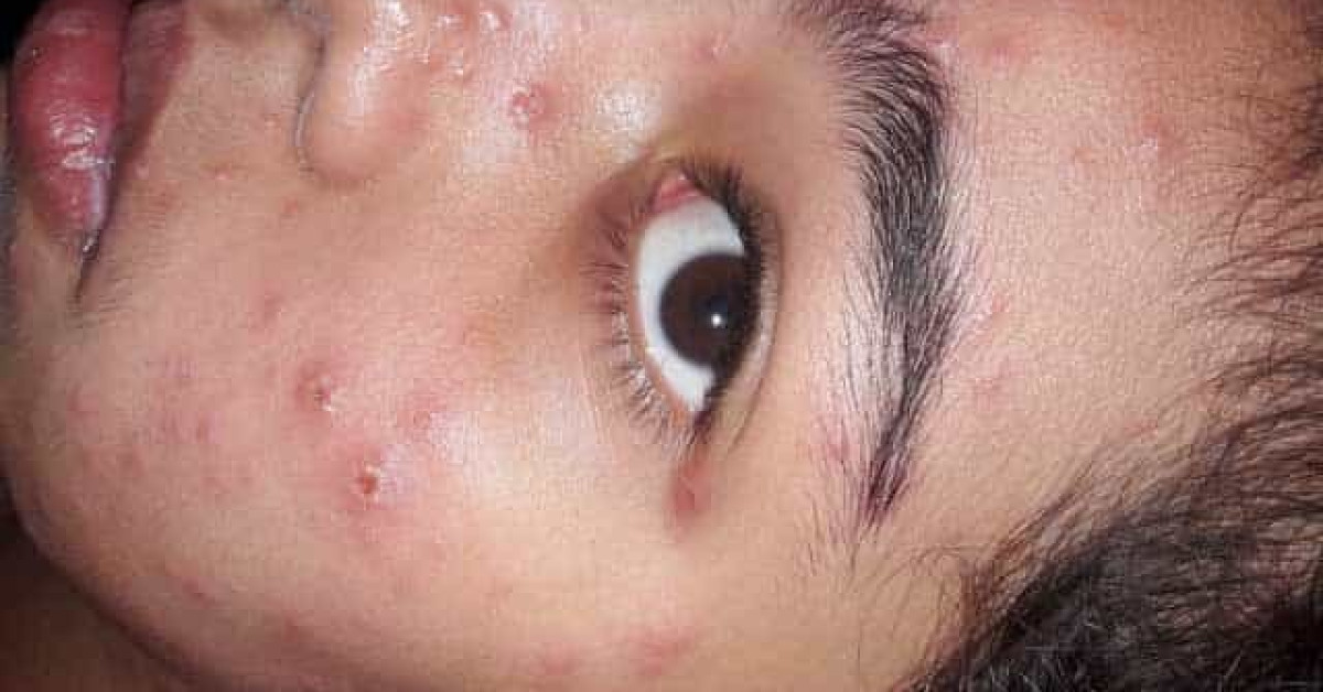 Chickenpox image