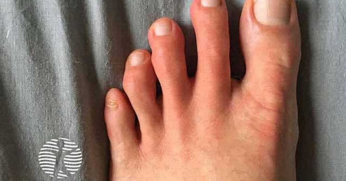 covid 19 skin rash 00001 image