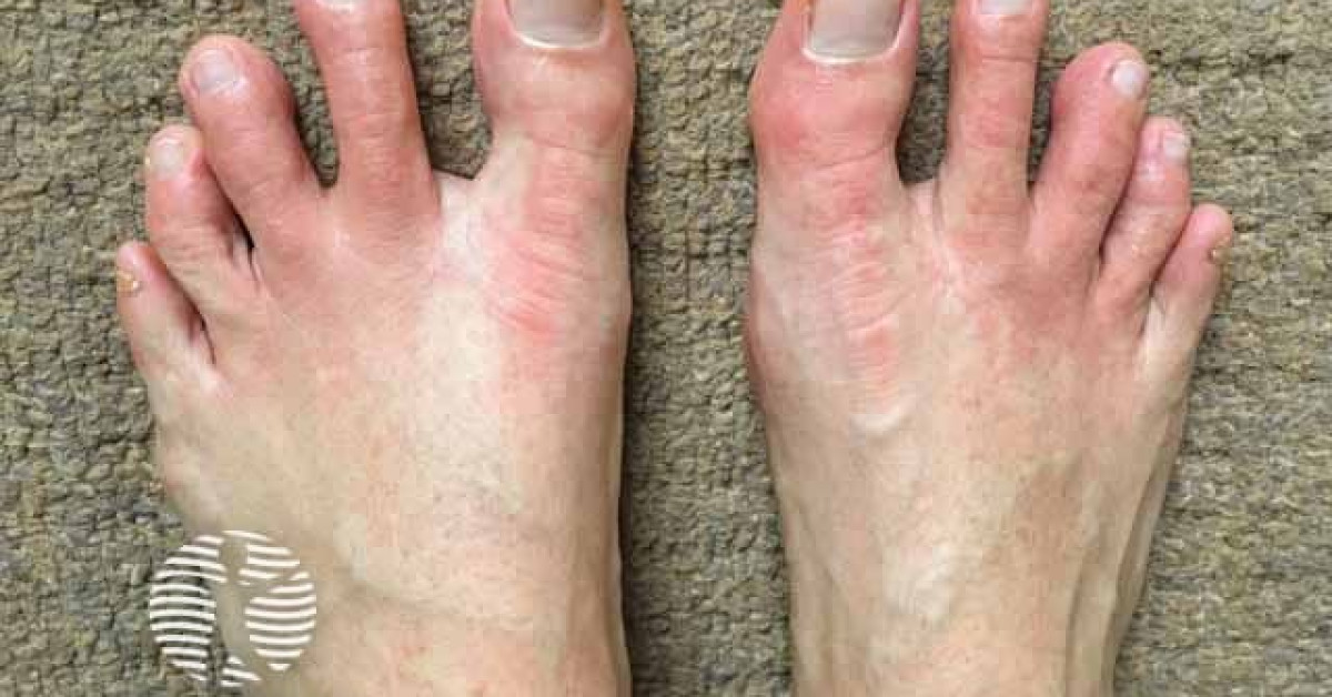 covid 19 skin rash 00005 image