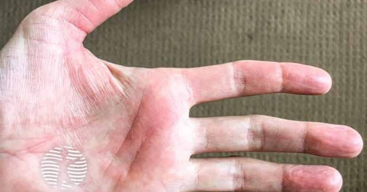 covid 19 skin rash 00008 image