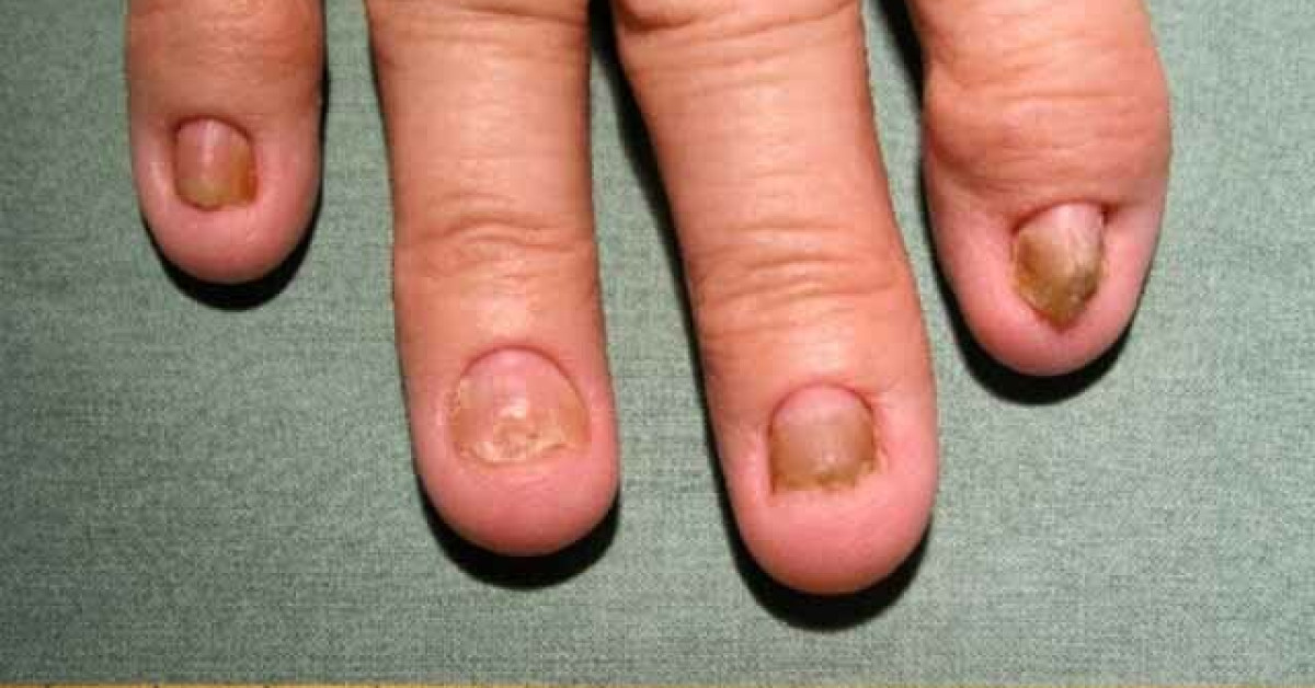 Cronkhite-Canada syndrome image