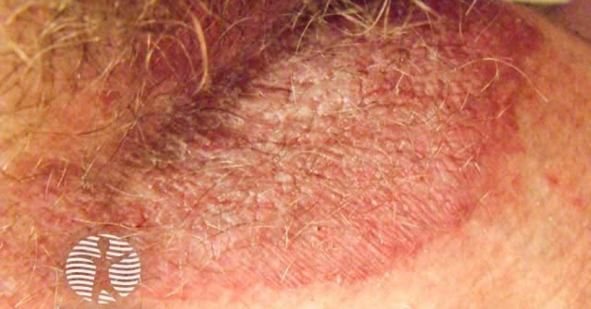 Hailey-Hailey disease image