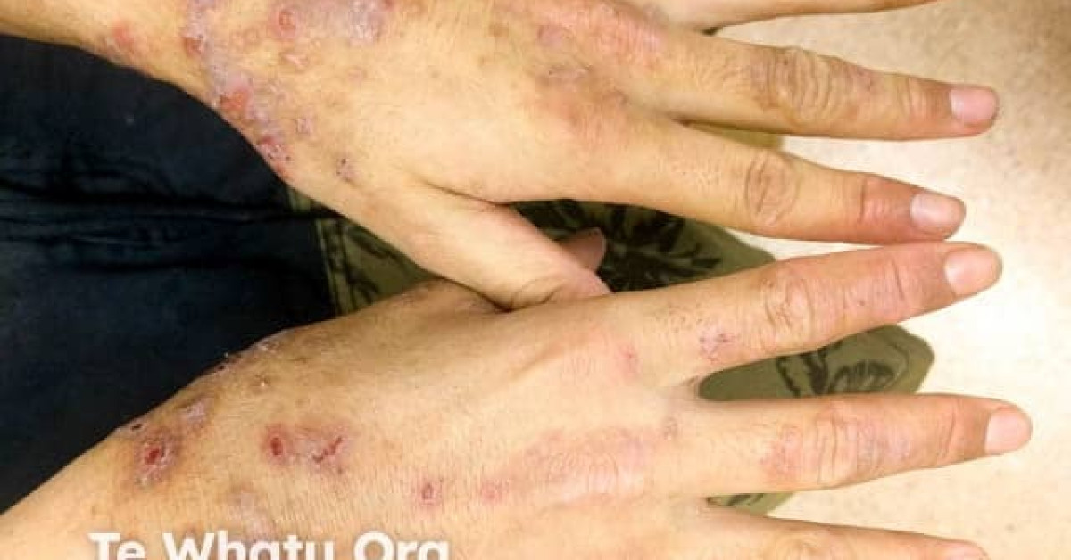 Hand dermatitis image