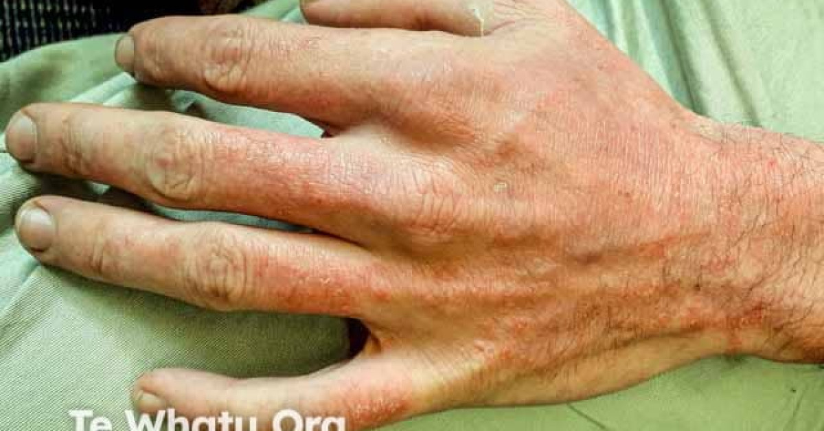 Hand dermatitis image