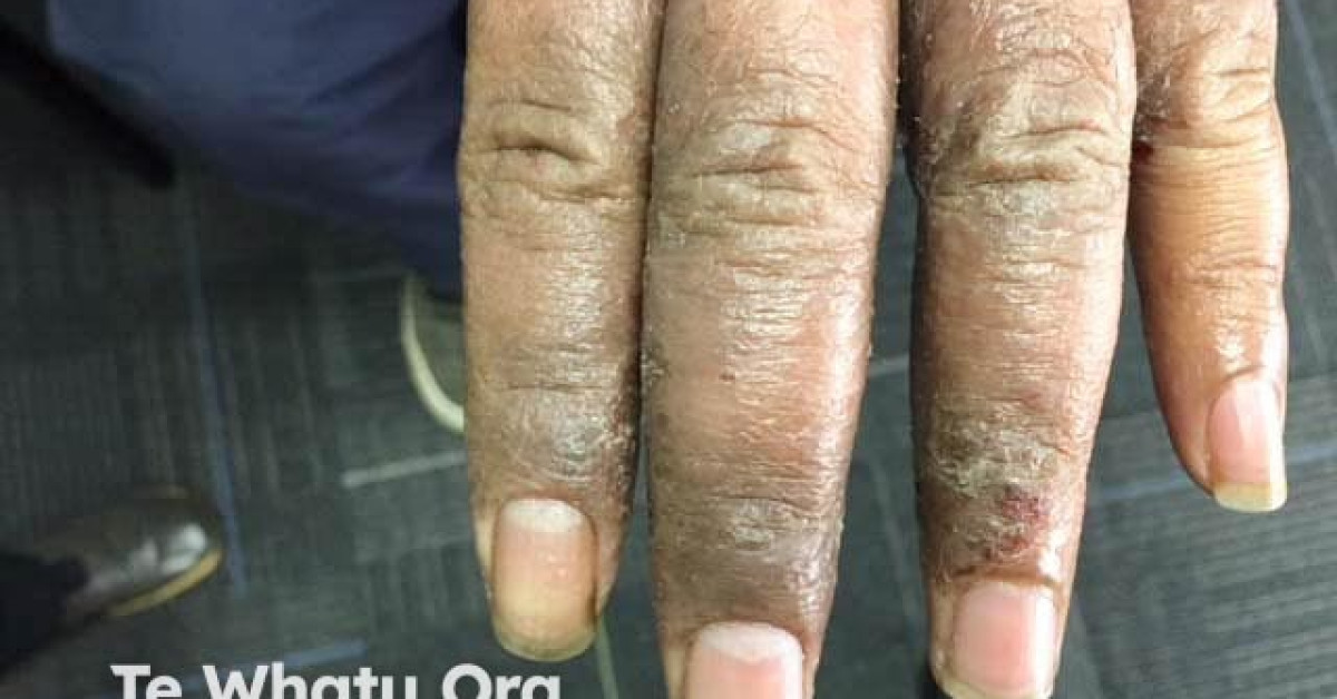 Hand dermatitis image