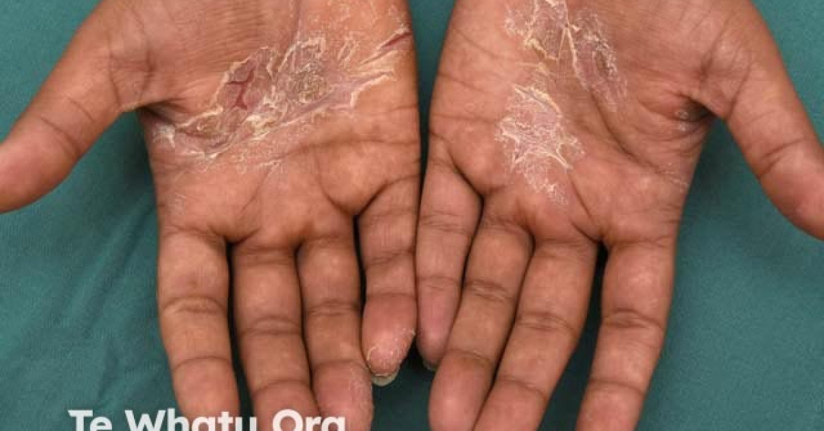 Hand dermatitis image