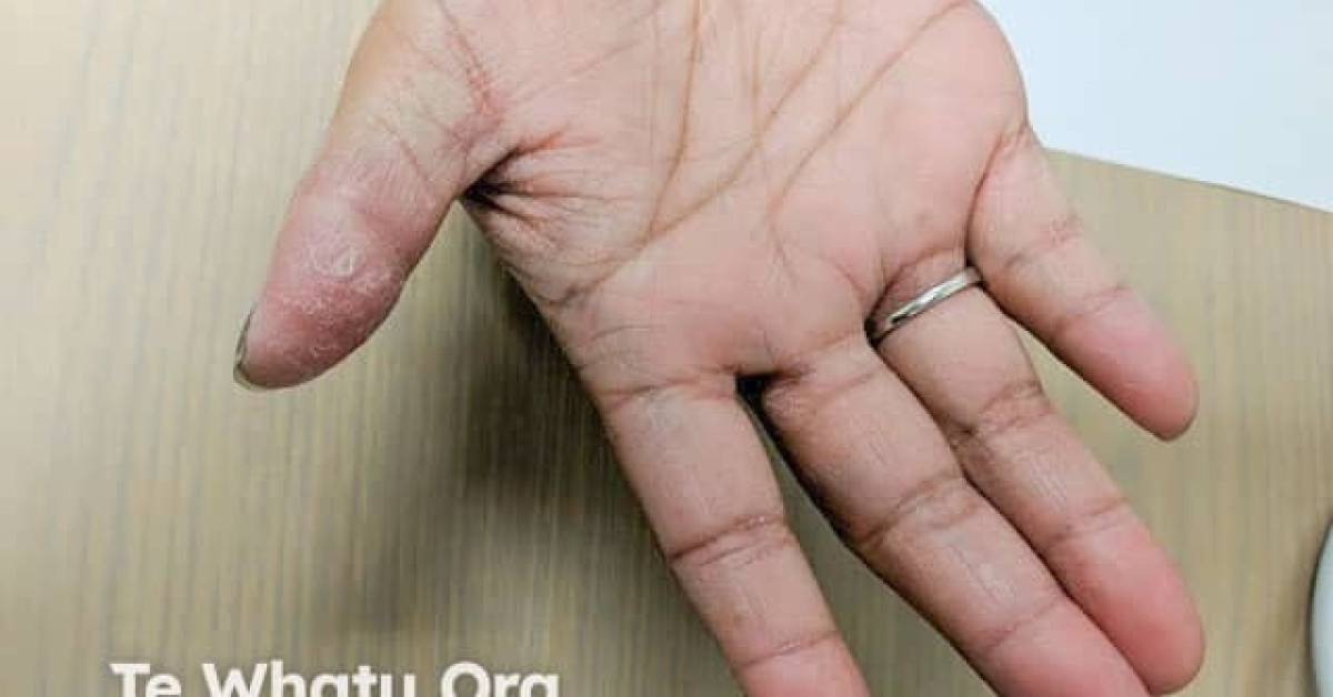 Hand dermatitis image