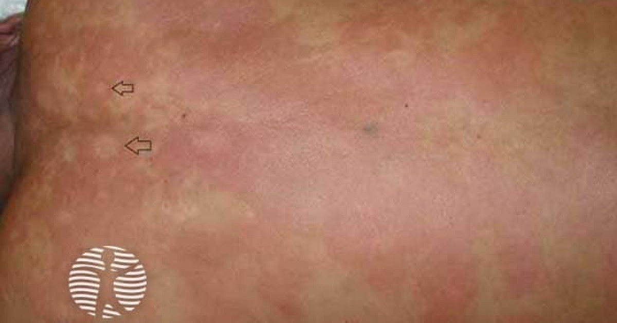 Leprosy borderline image