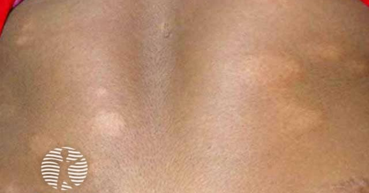 leprosy borderline lepromatous 00001 image