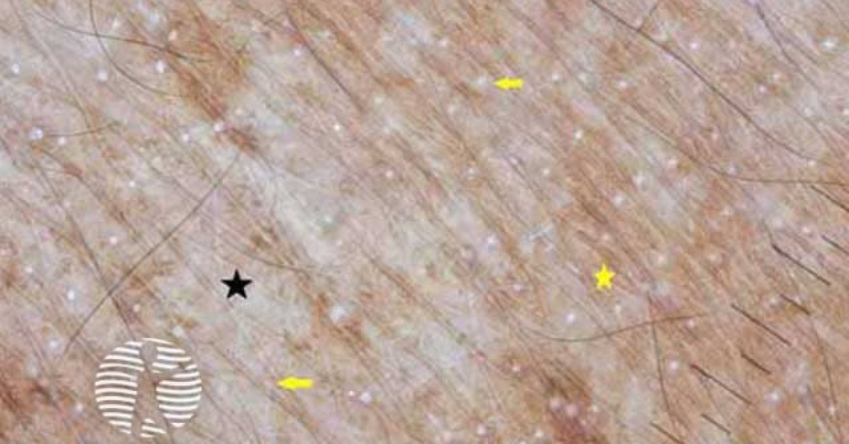 leprosy borderline tuberculoid dermoscopy 00003 image