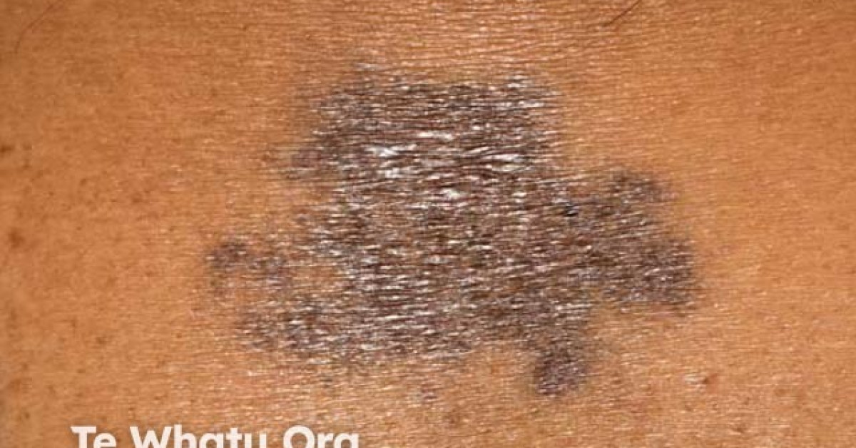 Lichenoid keratosis image