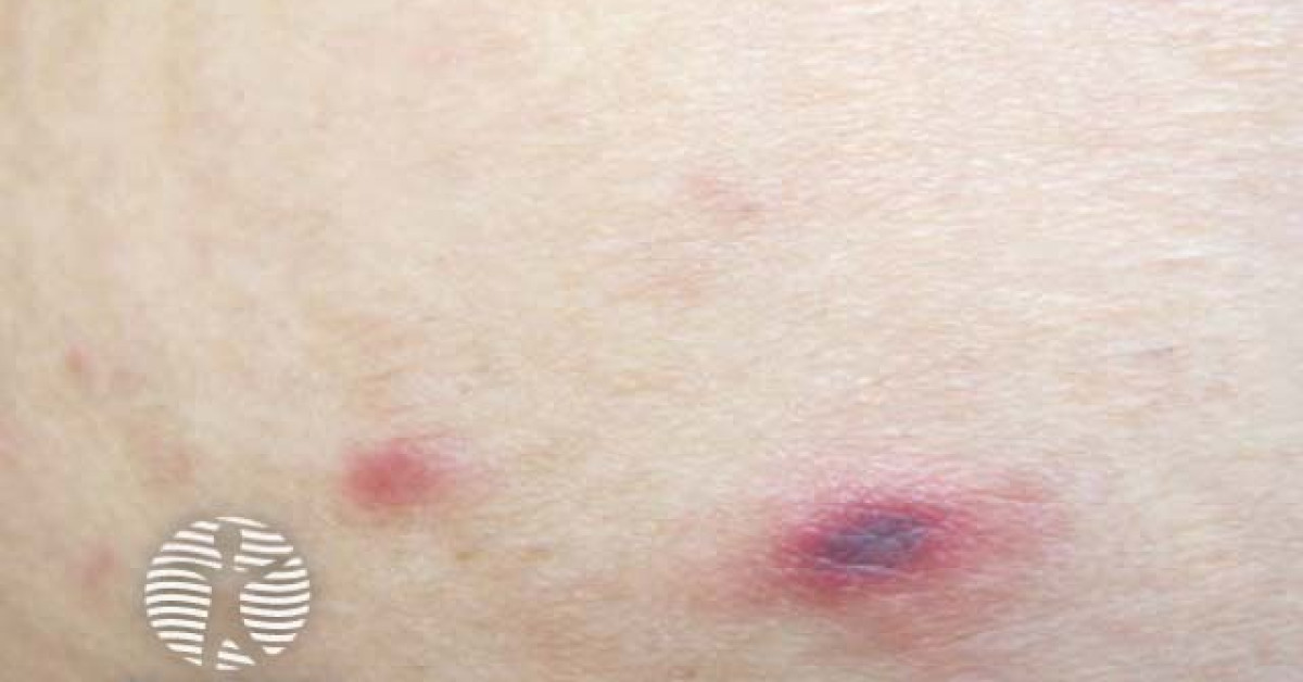 Lymphomatoid papulosis image