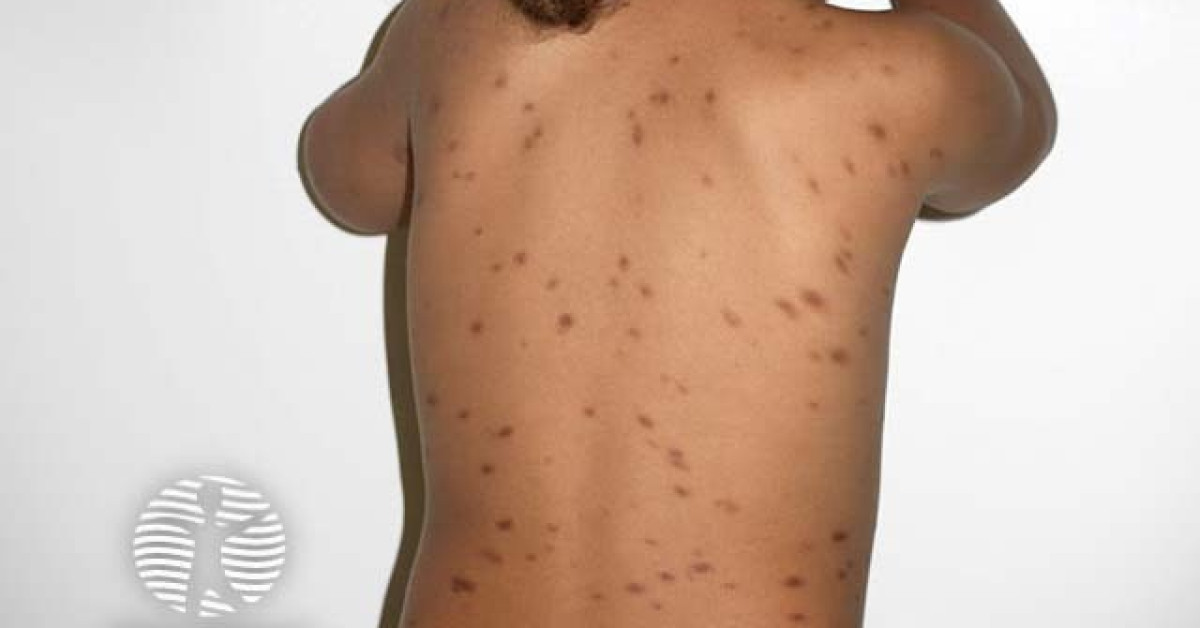 Maculopapular cutaneous mastocytosis image