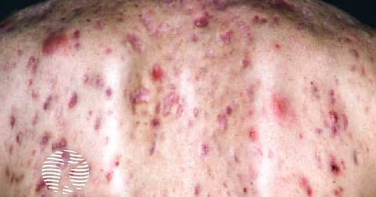nodulocystic acne 00011 image