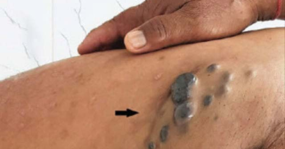 Cutaneous onchocerciasis image