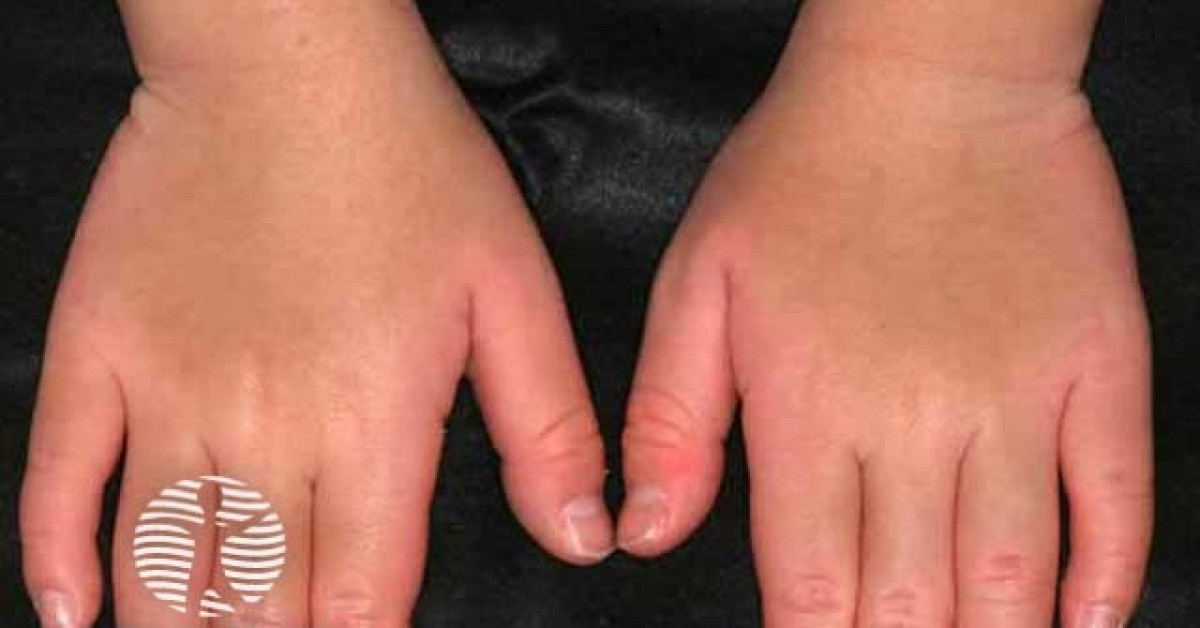 palmoplantar keratoderma nagashima type 00005 image