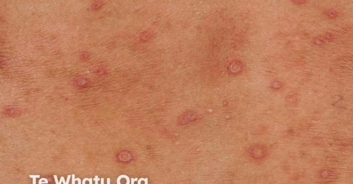 papular pruritic eruption of hiv 00017 image